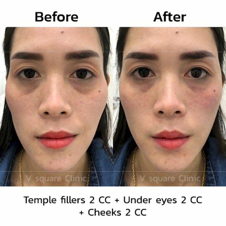 Cheek Fillers have 7 advantages, they fill the cheeks for a full look ...