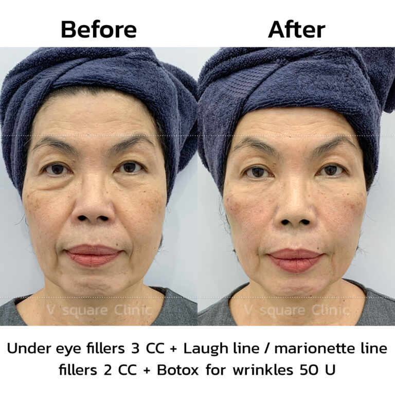 Tear groove filler is an age-defying wrinkle remover making the face ...