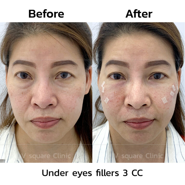 Tear groove filler is an age-defying wrinkle remover making the face ...