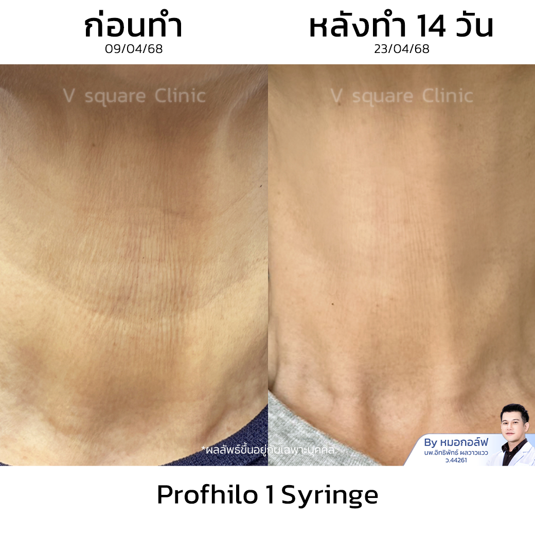 Profhilo Treatment – What Is It and Who Is It For?