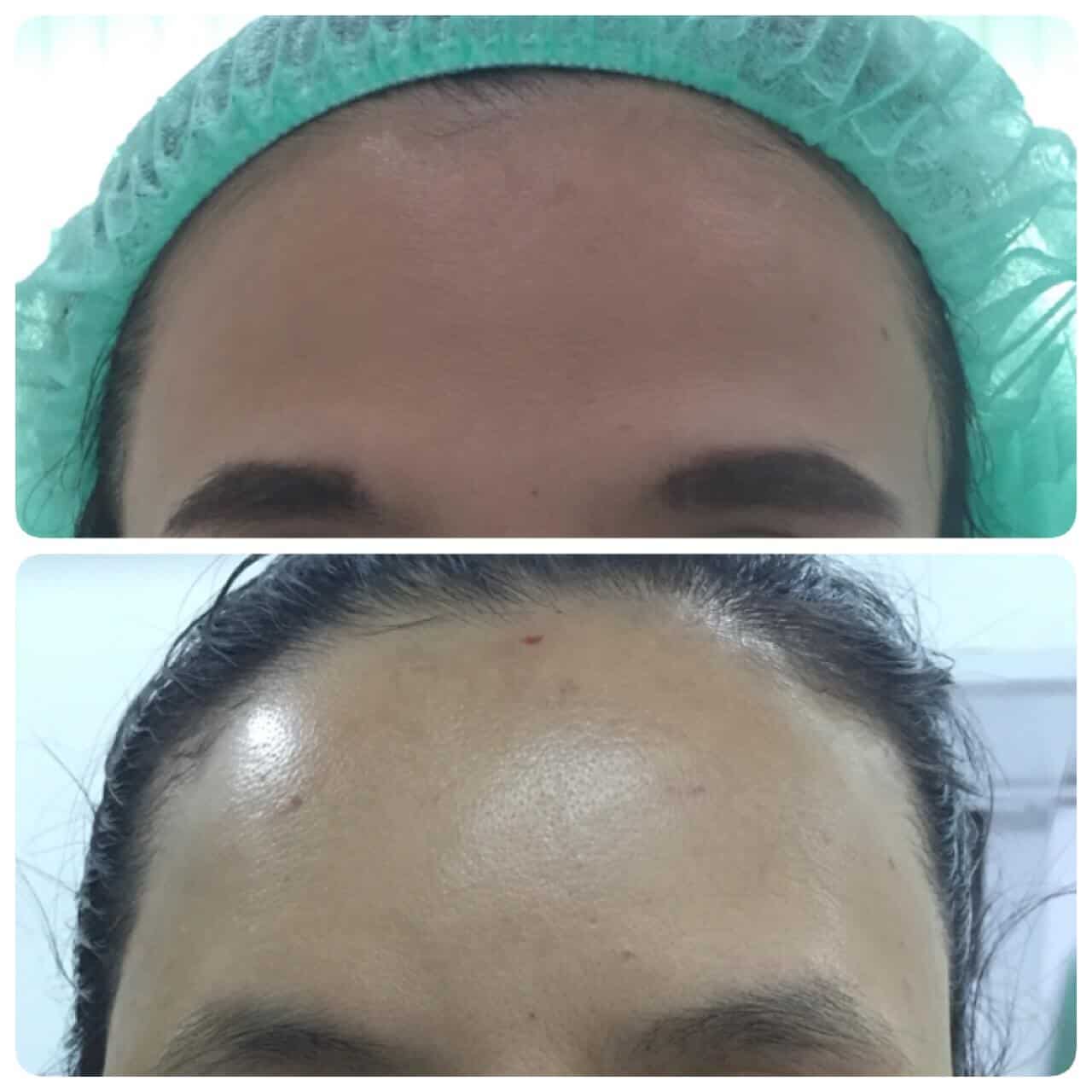 Forehead Filler vs Implants — Which Is the Better Choice