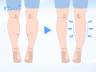 Calf Botox: What to Know, Benefits & How Soon It Works