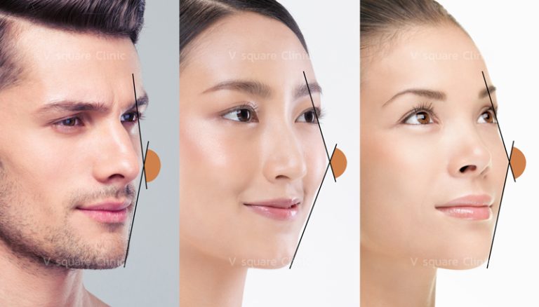 Orange Cheek Filler: Midface Lift for a Youthful Look
