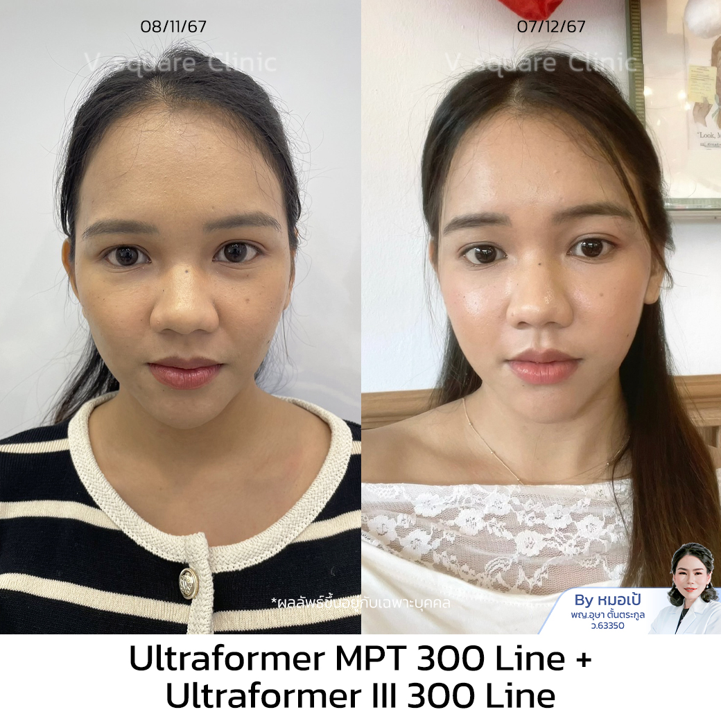 Ultraformer III: Non-Surgical Lift and Wrinkle Reduction
