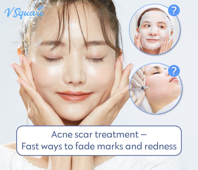 Acne scar treatment: 15 effective methods and fast results