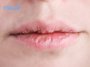 Chapped Lips: Causes & Ways to Treat Dry, Cracked Lips