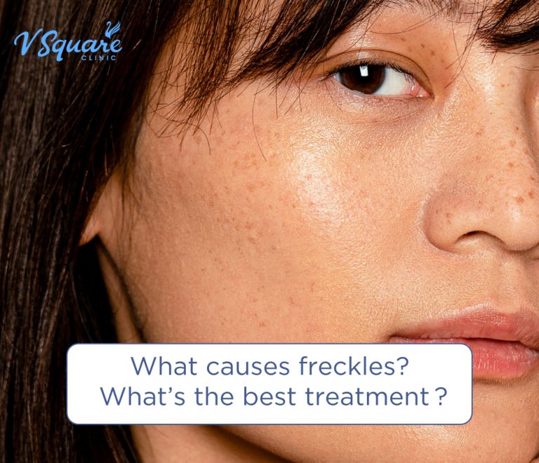 Freckles – Causes and Treatments for Clear, Smooth Skin