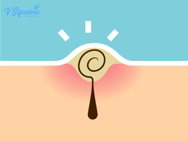 Ingrown Hair: Causes, Treatment, and Prevention